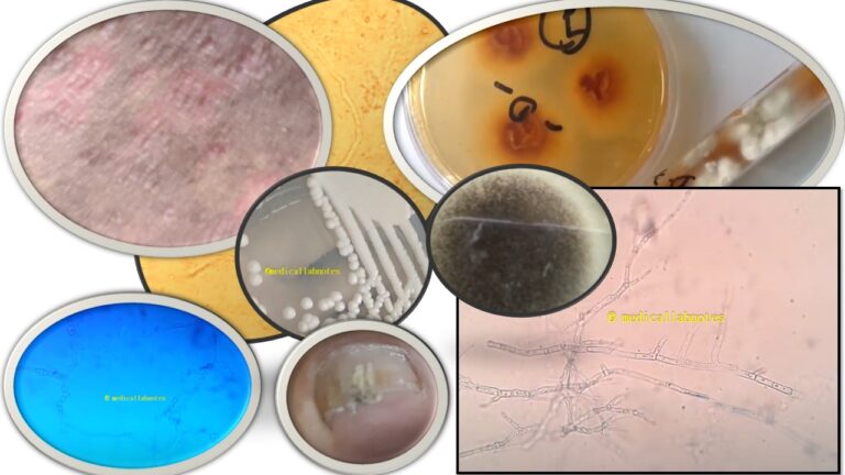 Fungal Disease: List, and Keynotes