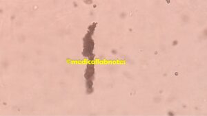 Urine Casts: Introduction, Identification Features, and Clinical