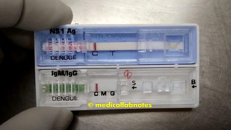 Dengue Rapid Test for IgG and IgM Detection: Introduction, Princi
