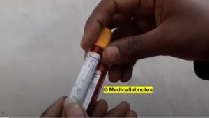 Ceruloplasmin Test-Introduction, Test Result, Unit, Reference