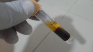 Serum creatinine test normal range Archives - Medical Notes