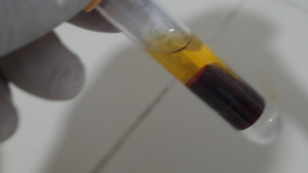 Globulin blood test normal range Archives - Medical Notes