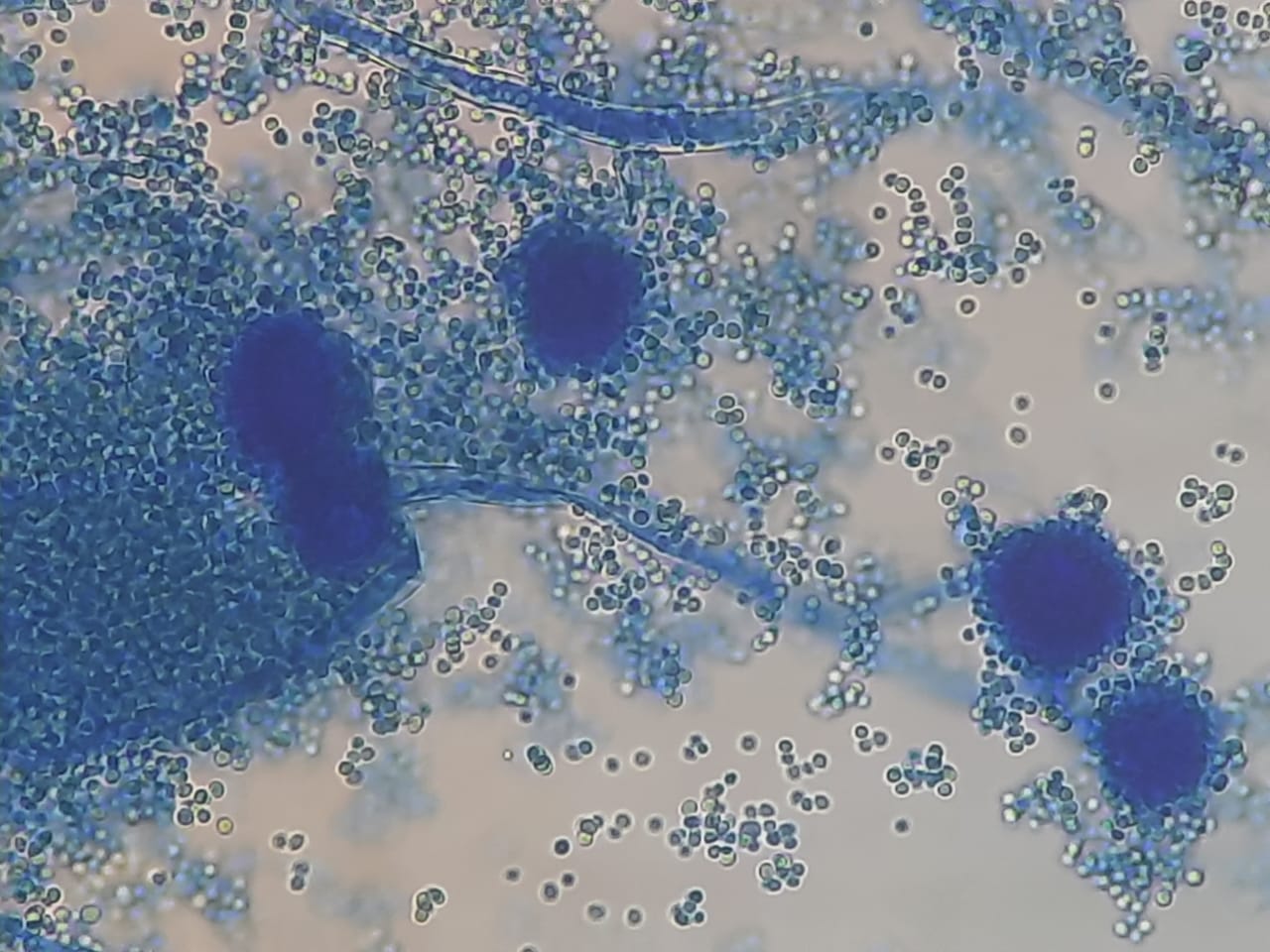 Fungal Pneumonia-Introduction, Common fungi, Clinical Feature