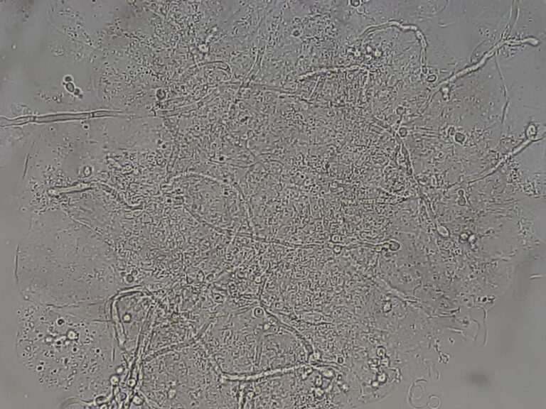 Funguria-Introduction, Common fungi, Clinical Feature, Lab Diag