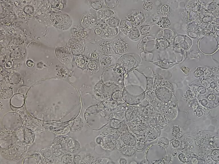 Ascitic Fluid Microscopy: Introduction, Principle, Test Requirements