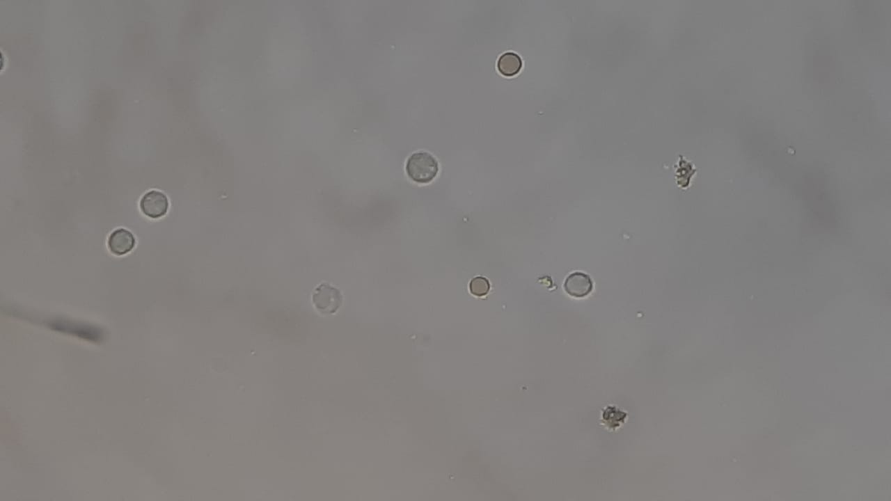 Pleural Fluid Microscopy: Introduction, Principle, Test Requirement
