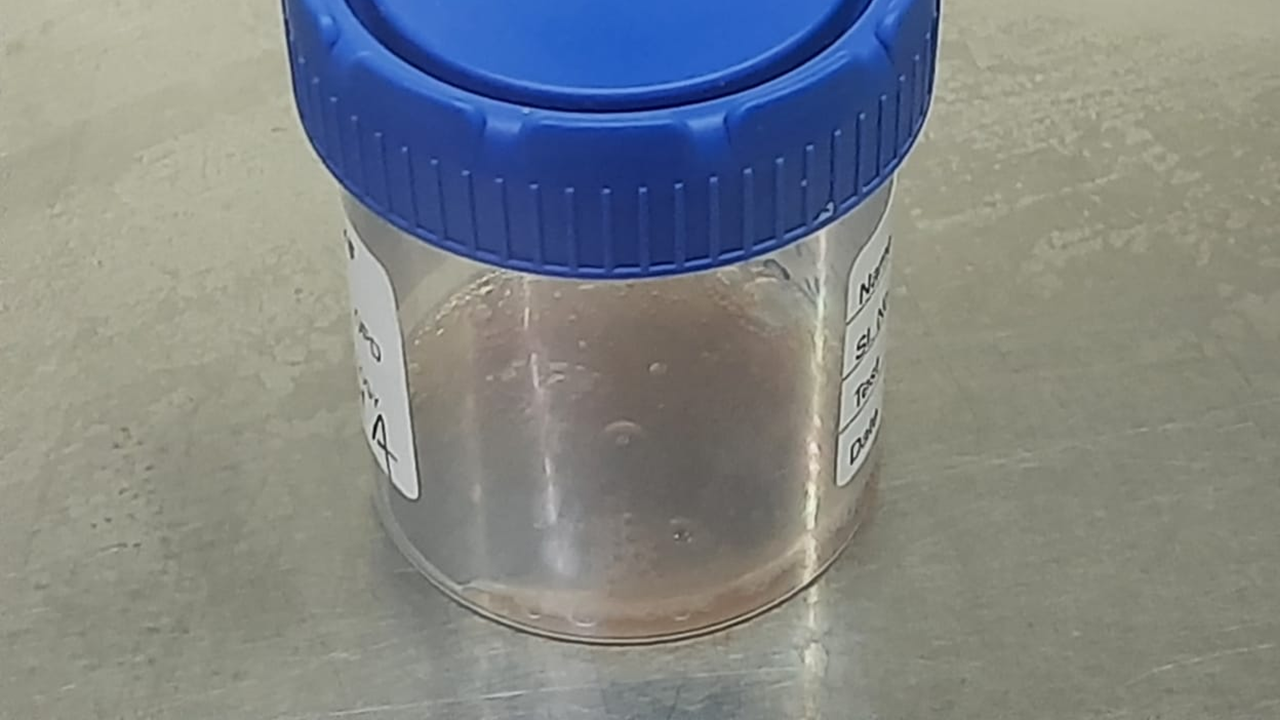 Fungal Elements in KOH Mount of Sputum Microscopy-Introduction