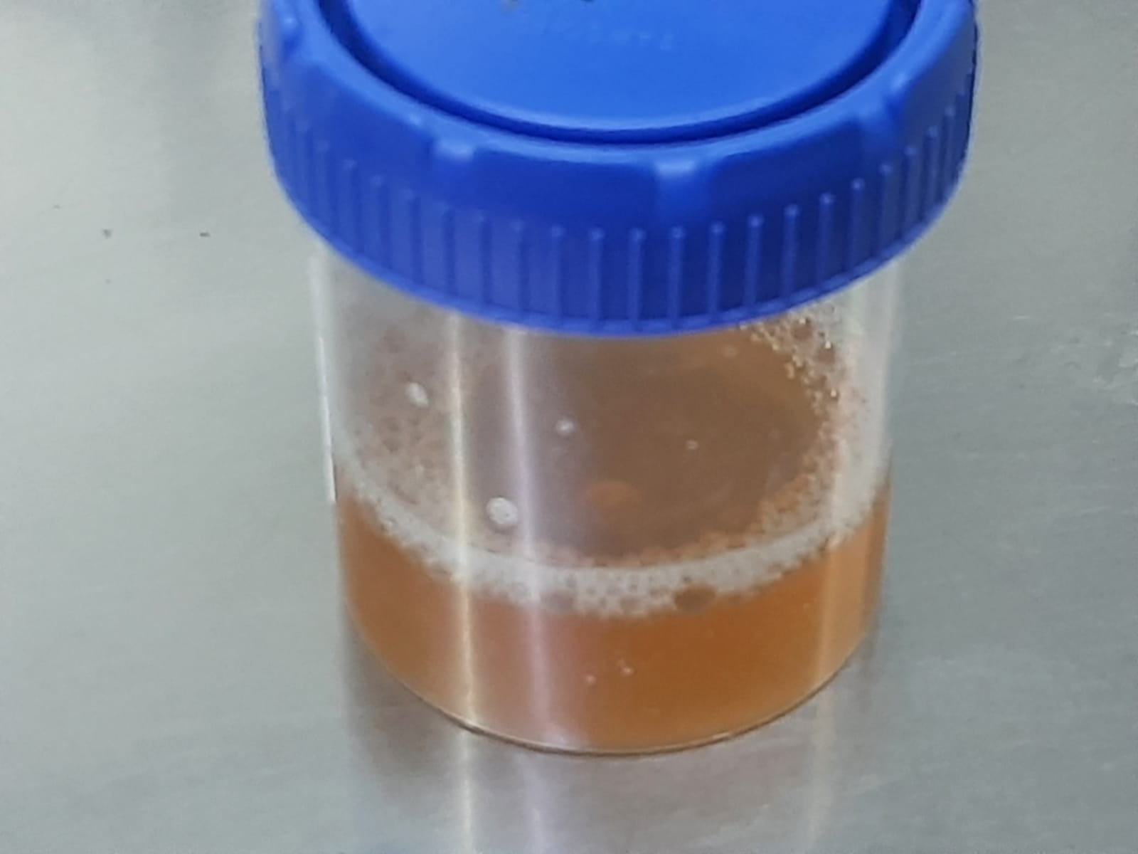 Fungal Elements in KOH Mount of Urine Microscopy: Introduction