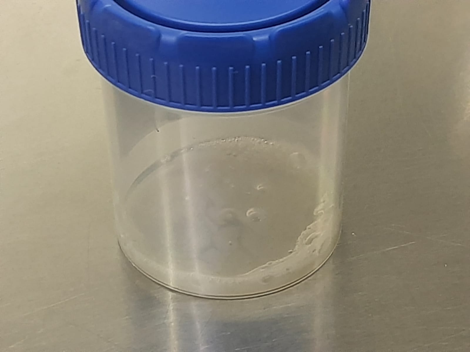 BAL Sample vs Sputum Sample – Key Differences